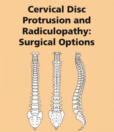 Cervical Disc Protrusion and Radiculopathy: Surgical Options - Spine ...