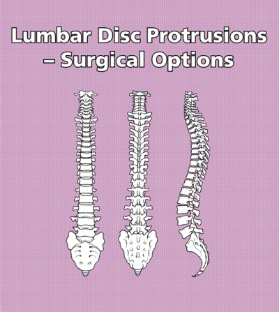 Lumbar Discs Protrusions - Surgical Options - Spine and Brain