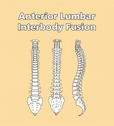 Anterior Lumbar Interbody Fusion - Spine and Brain