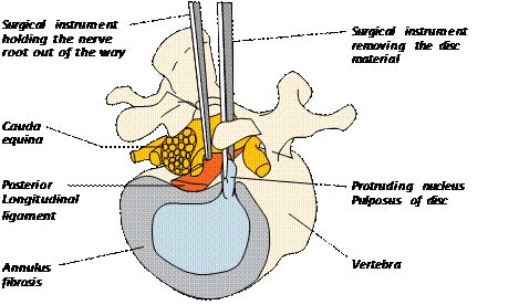 Lumbar Discs Protrusions - Surgical Options - Spine and Brain