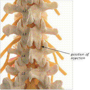 Lumbar Facet Joint Syndrome - Injection Treatment - Spine and Brain