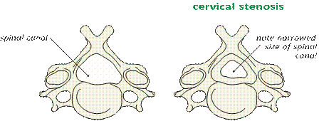 Cervical Stenosis and Myelopathy: Surgical Options - Spine and Brain