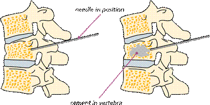 Vertebral Compression Fracture: Vertebroplasty and Kyphoplasty - Spine ...