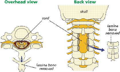 Cervical Stenosis and Myelopathy: Surgical Options - Spine and Brain