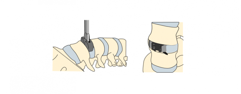 Lumbar Spondylolysis and Spondylitic Spondylolisthesis - Surgical ...