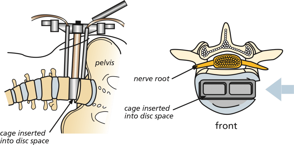 Symptomatic Degenerative Lumbar Disc Disease: Surgical Options - Spine ...