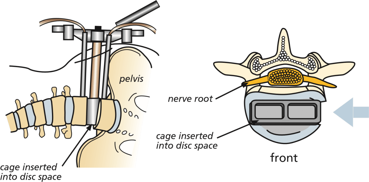 Symptomatic Degenerative Lumbar Disc Disease: Surgical Options - Spine ...