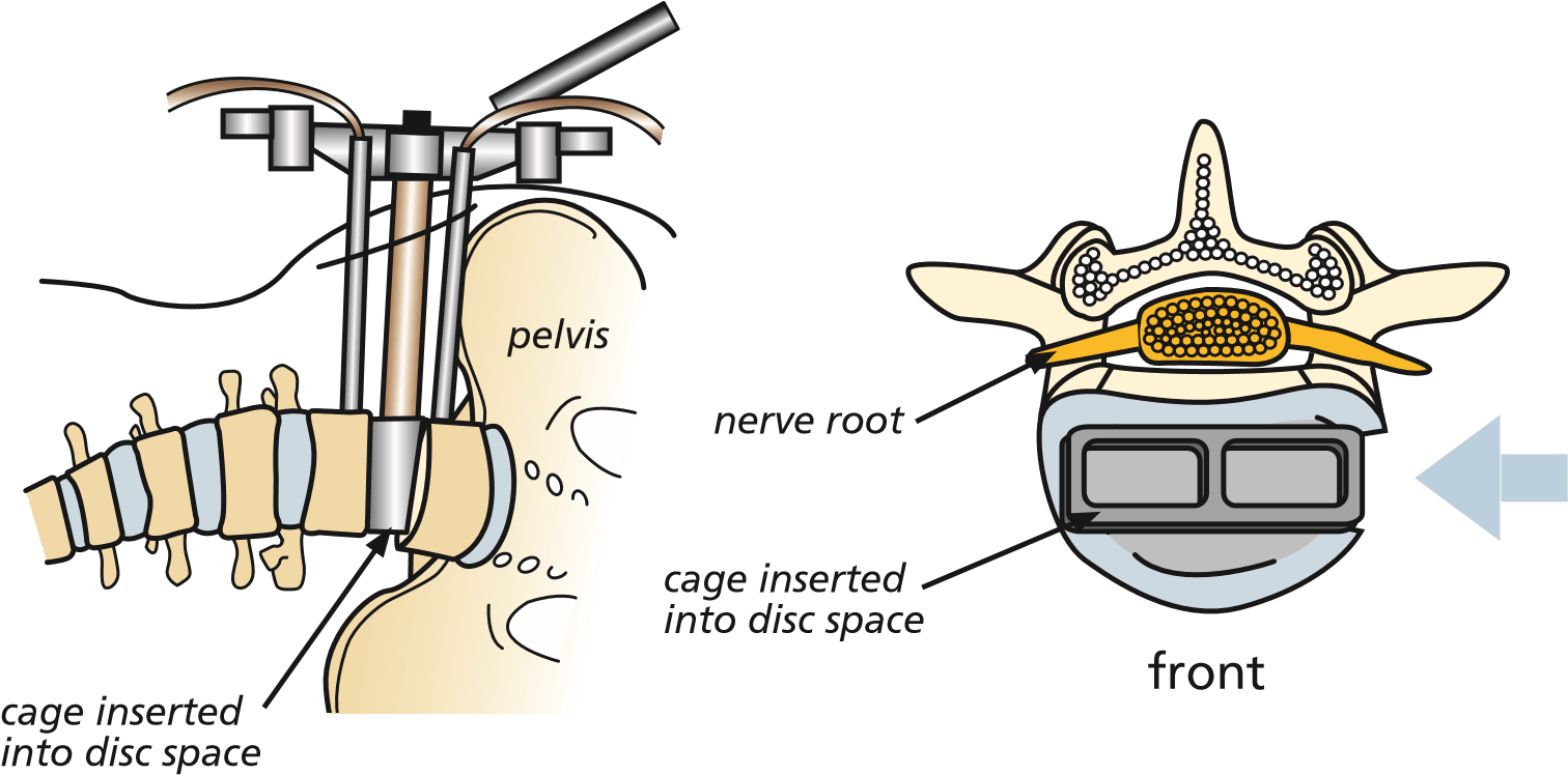 Symptomatic Degenerative Lumbar Disc Disease: Surgical Options - Spine ...