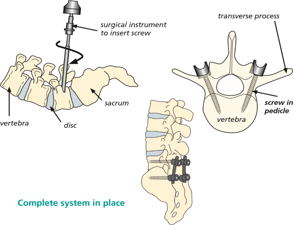 Lumbar Spondylolysis and Spondylitic Spondylolisthesis - Surgical ...