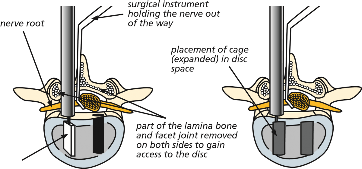 Symptomatic Degenerative Lumbar Disc Disease: Surgical Options - Spine ...