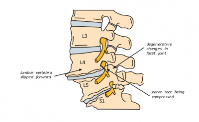 Lumbar Radiculopathy: Nerve Root Block / Foraminal Epidural Injection ...