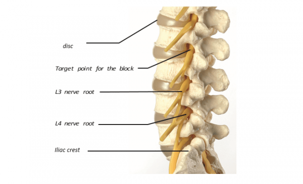 Lumbar Radiculopathy: Nerve Root Block / Foraminal Epidural Injection ...
