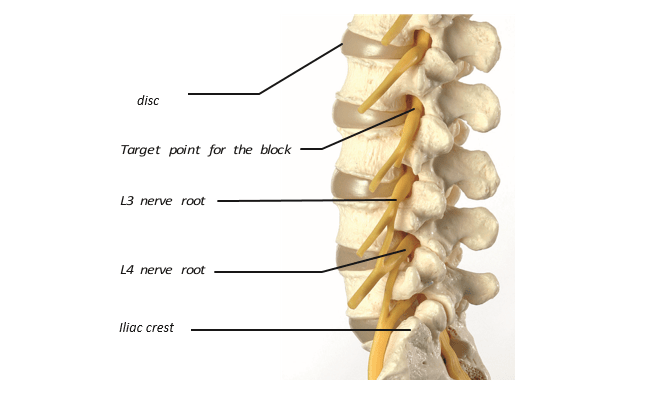Lumbar Radiculopathy: Nerve Root Block / Foraminal Epidural Injection ...