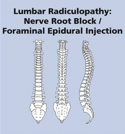 Lumbar Radiculopathy: Nerve Root Block / Foraminal Epidural Injection ...