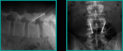 Lumbar Spondylolysis and Spondylitic Spondylolisthesis - Surgical ...
