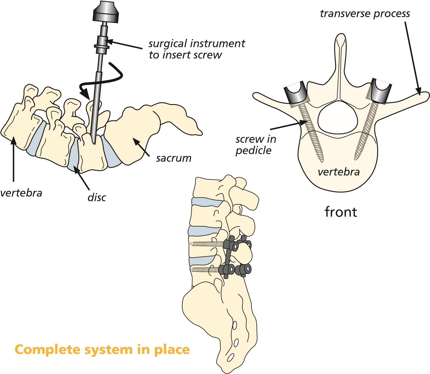 Symptomatic Degenerative Lumbar Disc Disease: Surgical Options - Spine ...