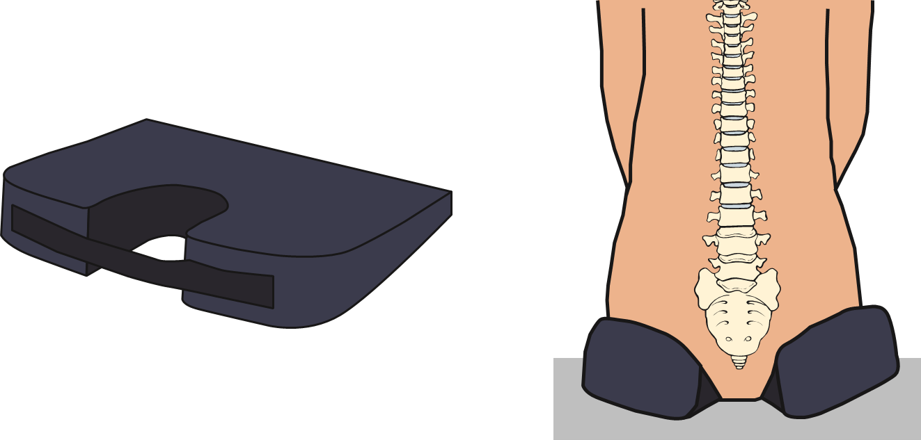 Coccydynia - Injection Treatment - Spine and Brain