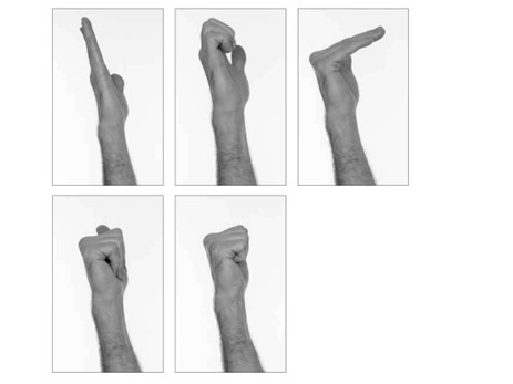 Carpal Tunnel Syndrome - Spine and Brain