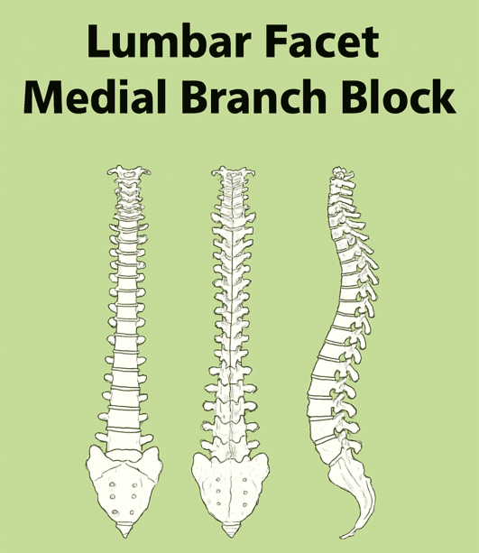 Facet Medial Branch Block - Spine and Brain