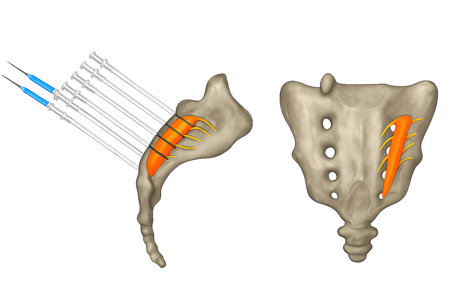 Sacroiliac Joint Radiofrequency Denervation - Spine and Brain